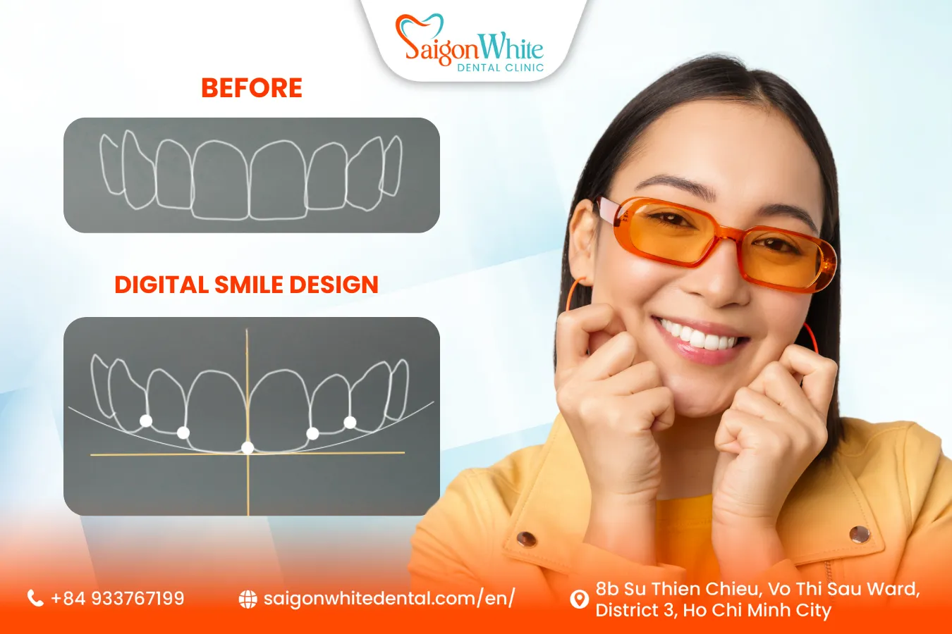 Digital Smile Design Service in Ho Chi Minh City - Saigon White Dental ...