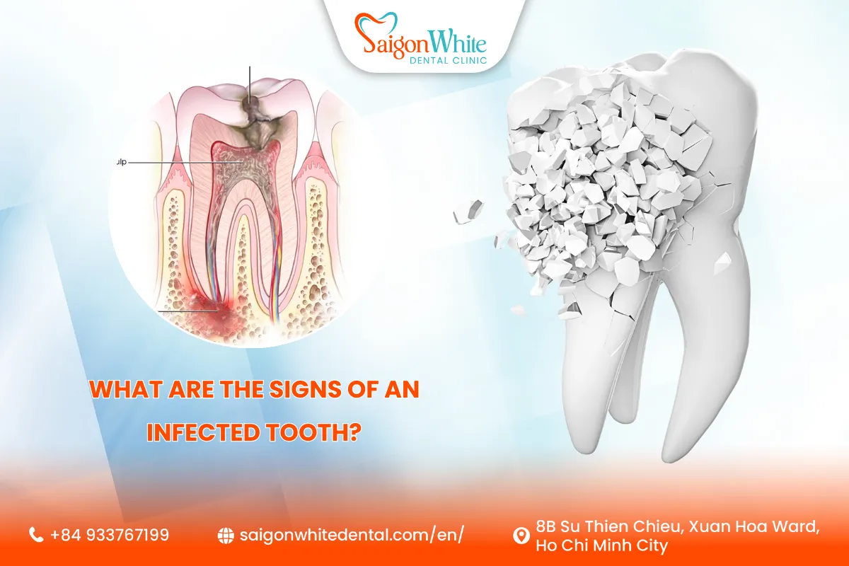 What are the signs of an infected tooth? - Saigon White Dental Clinic