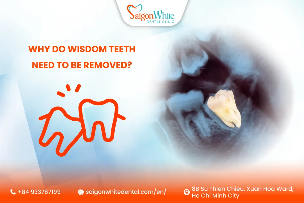Why do wisdom teeth need to be removed? - Saigon White Dental Clinic