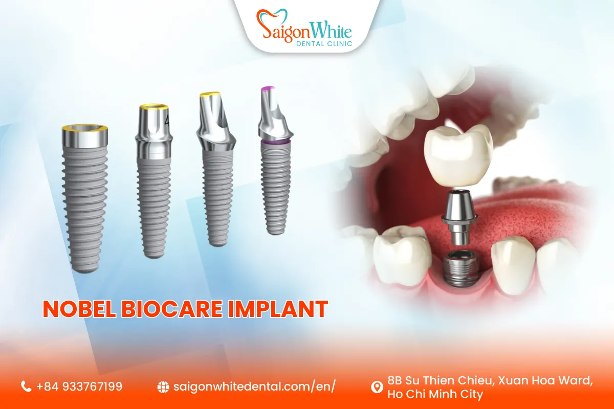 Nobel Biocare Implant in Vietnam: Affordable Premium Option - Saigon ...