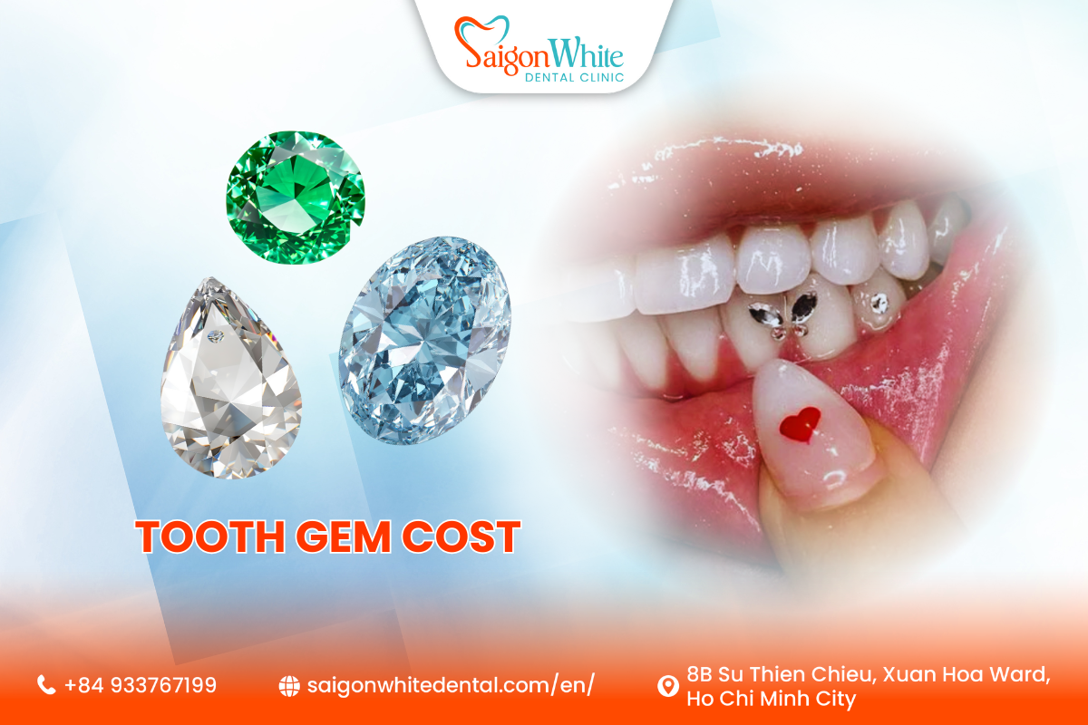 Tooth Gem Cost: How Much Does Dental Jewelry Really Cost? - Saigon ...