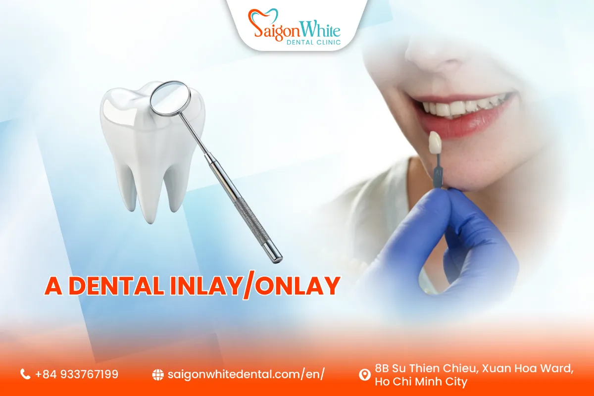 What Is a Dental Inlay/Onlay? Complete Guide for Patients - Saigon ...