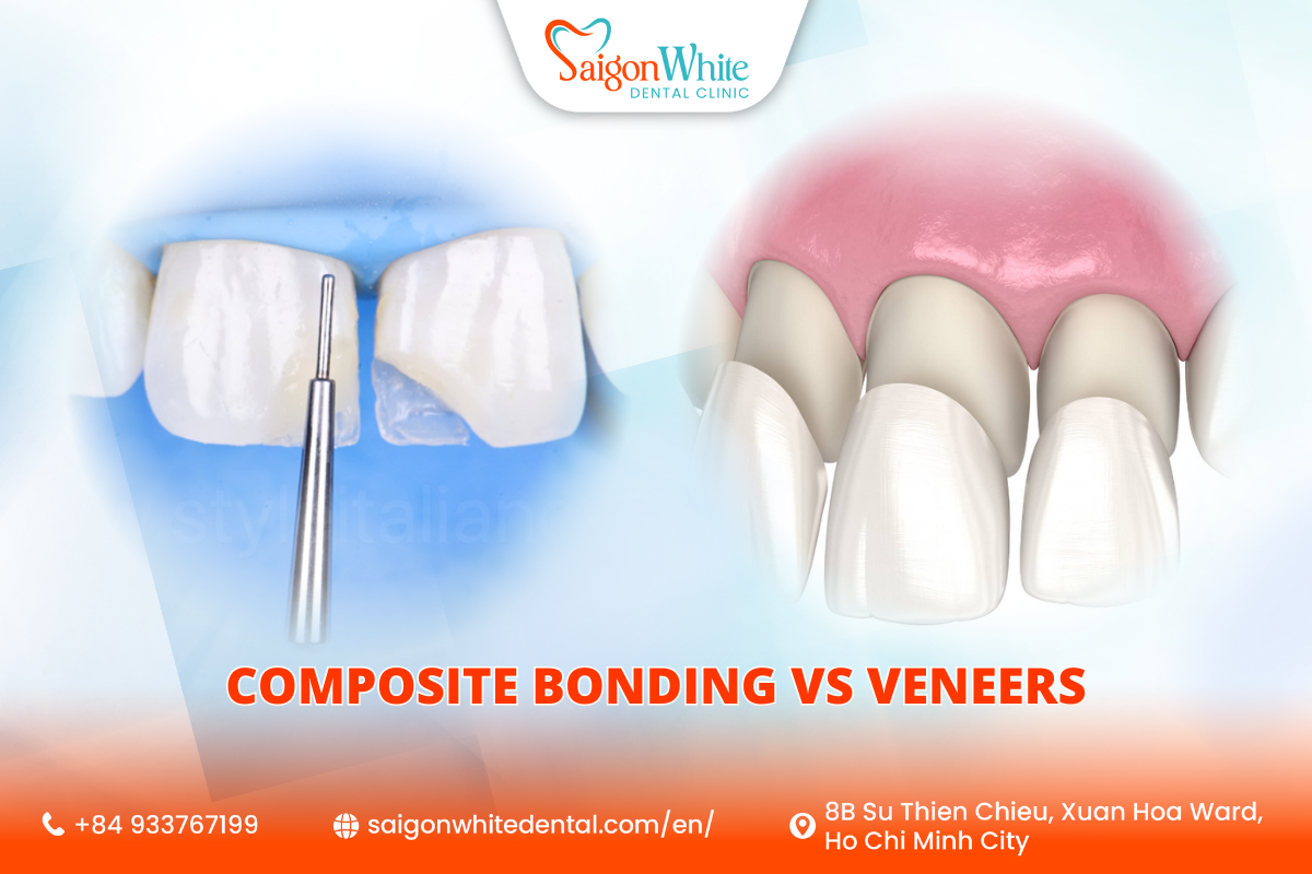 Composite Bonding vs Veneers: Which is Better for You in Vietnam ...