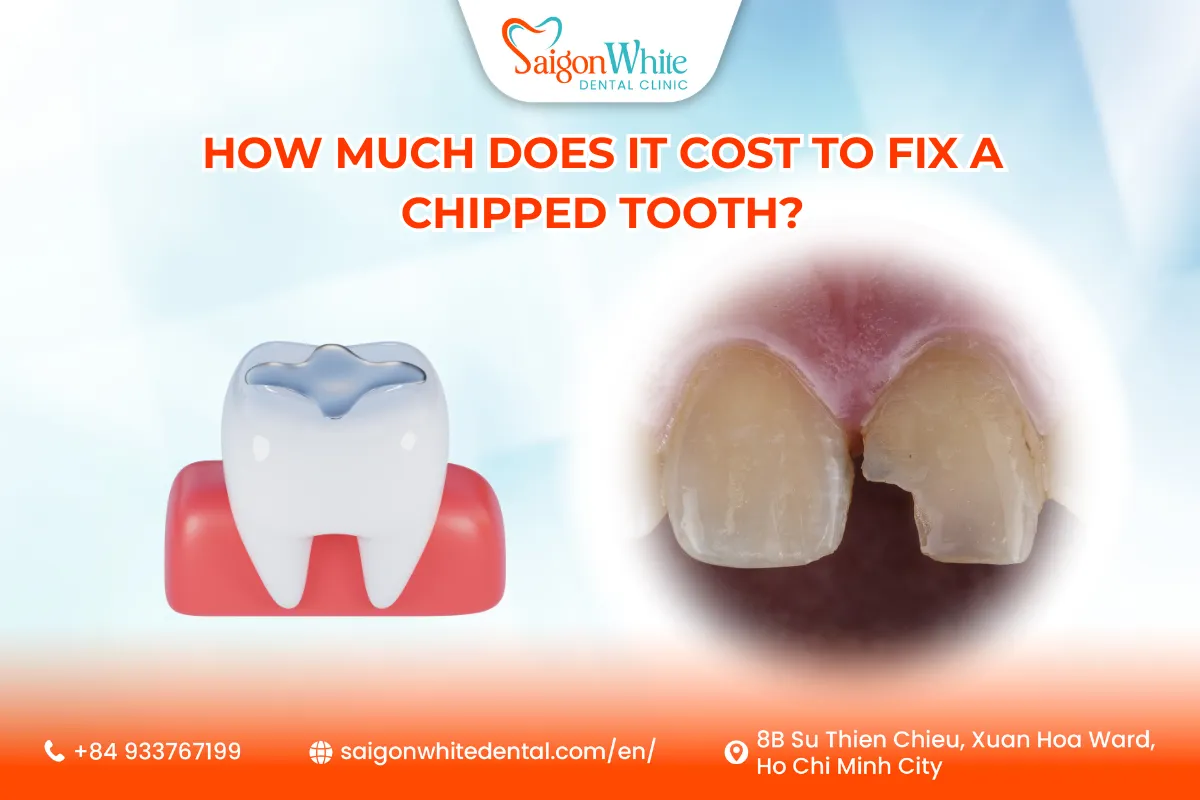 How much does it cost to fix a chipped tooth? - Saigon White Dental Clinic